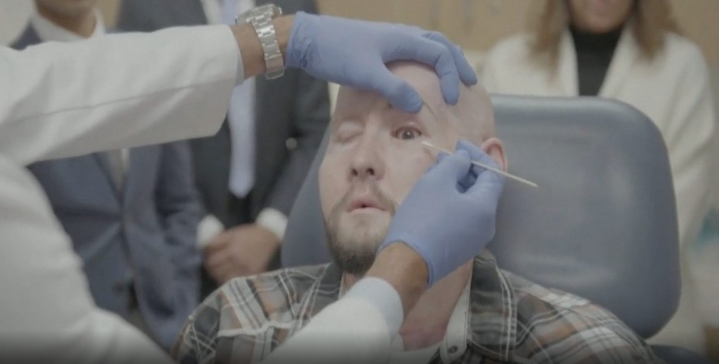 Trasplantan un ojo por primera vez en la historia